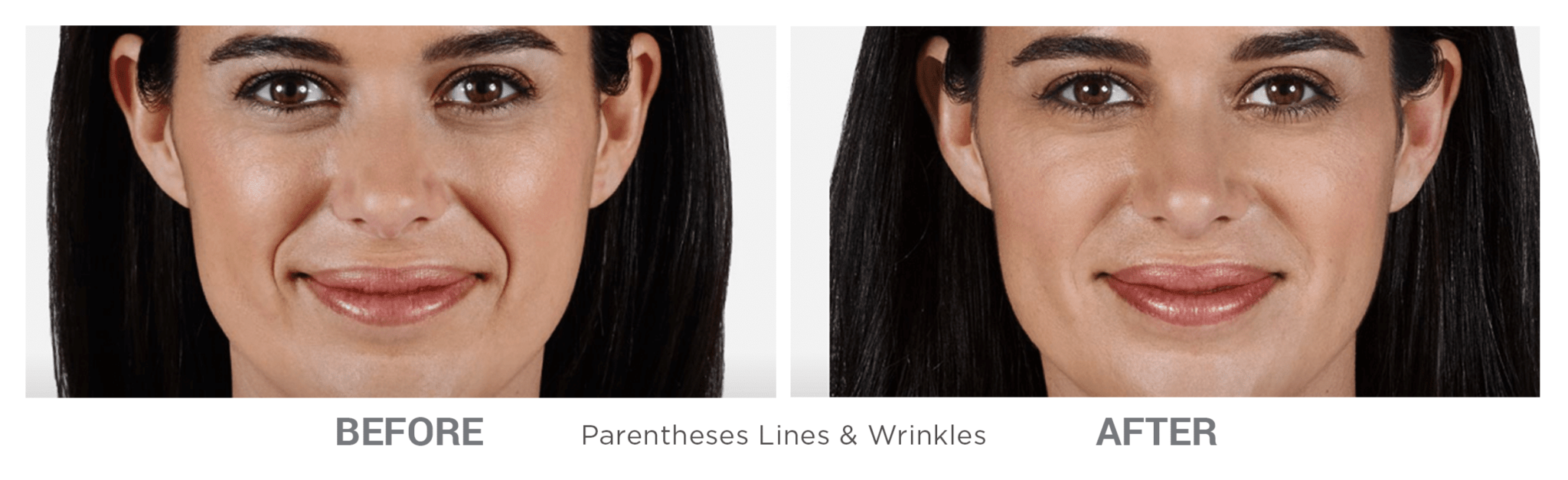 Botox in Reno, NV - Dolce Vita Wellness Spa